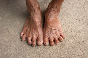 What is Toe Jam, and when is it a Problem? - UniScience Blog